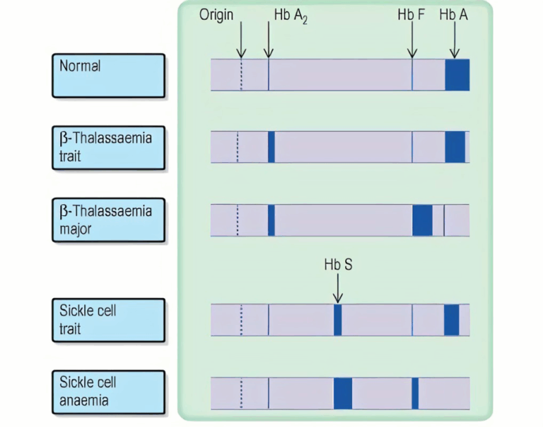 Diagnosis of Thalassemia • The Blood Project