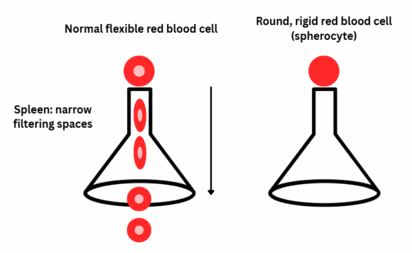Understanding Hereditary Spherocytosis • The Blood Project